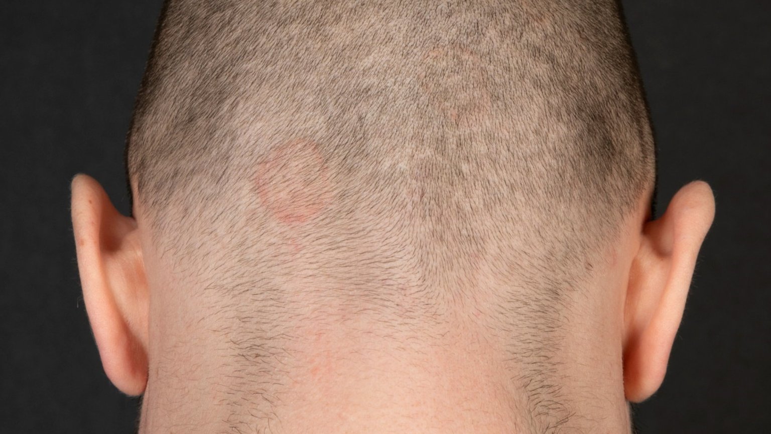 Ansteckungsgefahr in Barbershops: Ein Hautpilz verbreitet sich | BR24