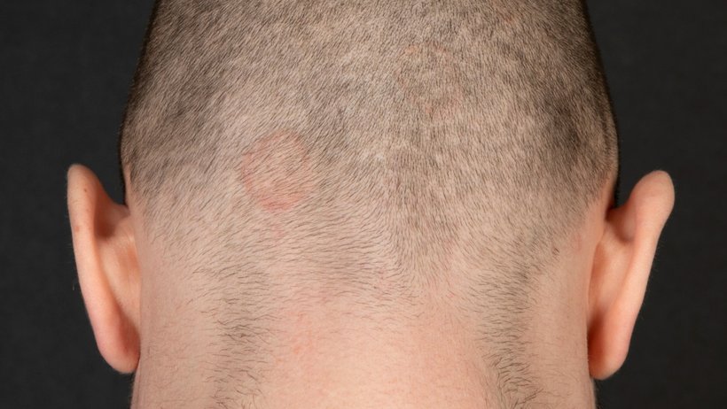 Ansteckungsgefahr in Barbershops: Ein Hautpilz verbreitet sich | BR24