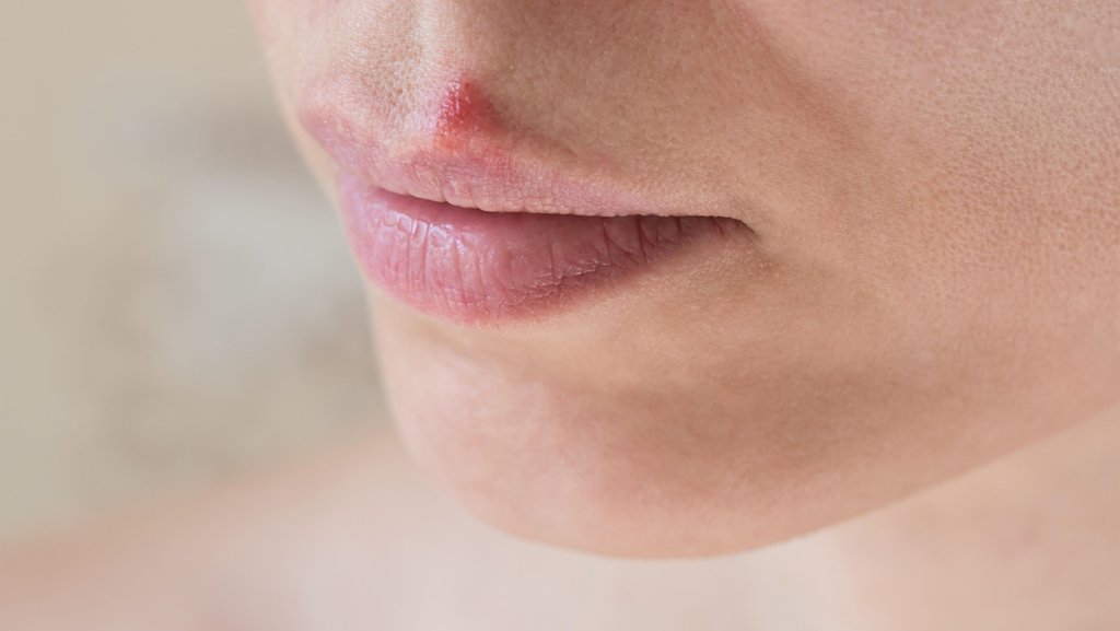 Herpes: Wie bekommt man Lippenbläschen schnell wieder weg? | BR24