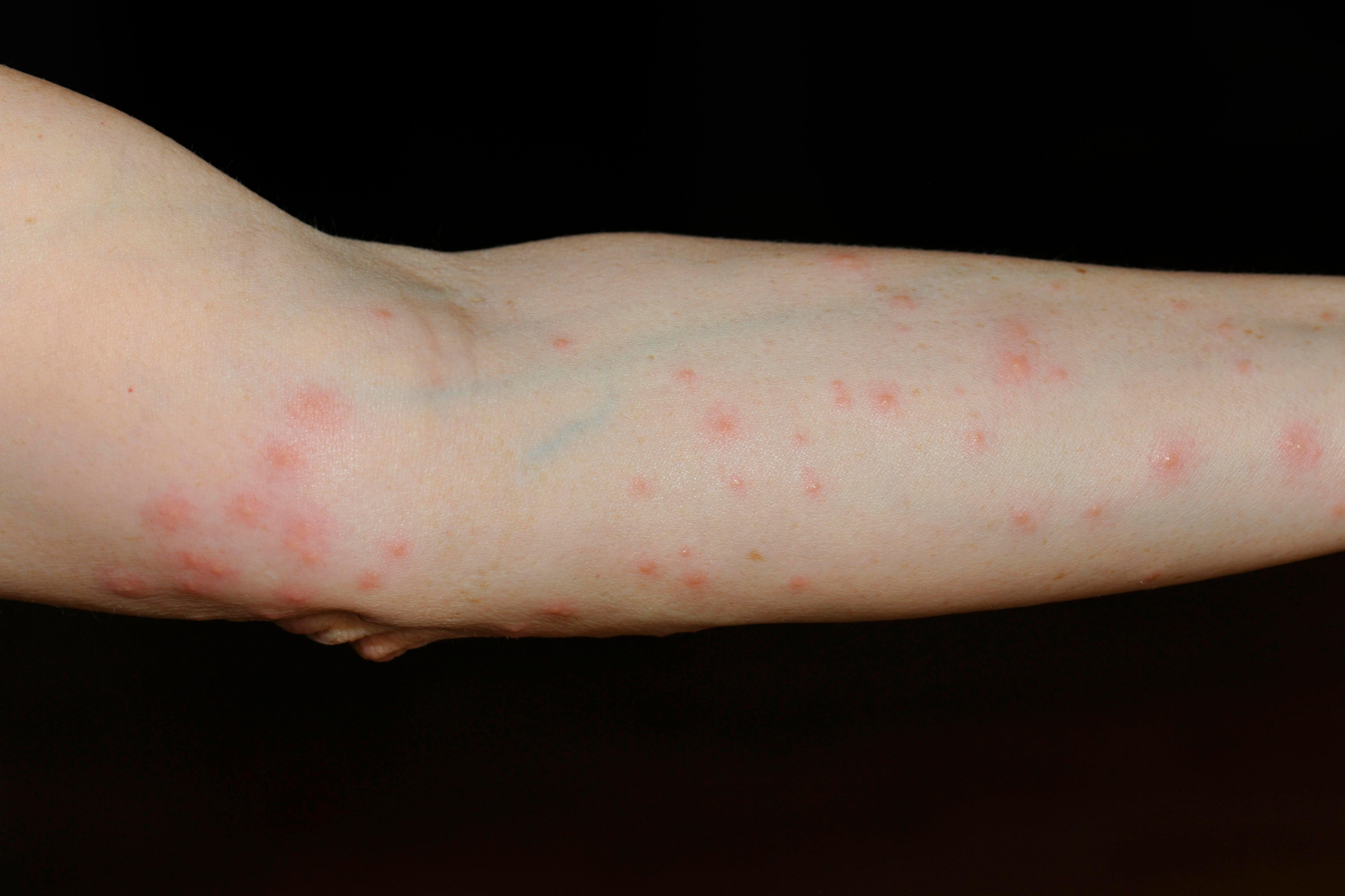 Grasmilben im Garten: Bisse erkennen und Juckreiz bekämpfen | BR24