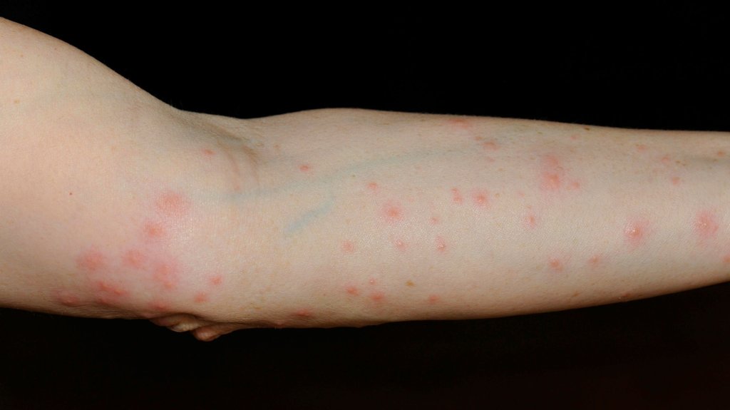 Grasmilben im Garten: Bisse erkennen und Juckreiz bekämpfen | BR24